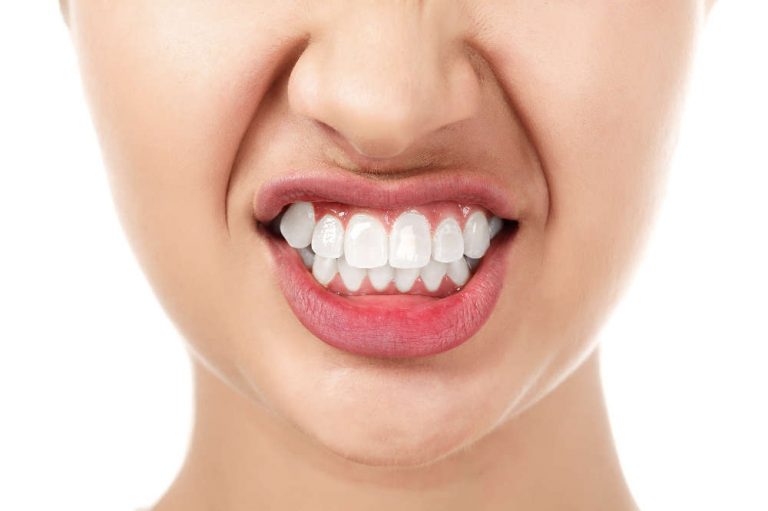 Solución al Bruxismo o Rechinamiento - Clínica Dental Nuño Gil